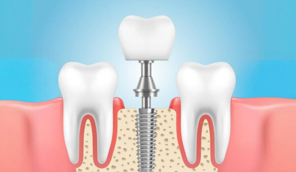 The Step-by-Step Process of Getting Dental Implants