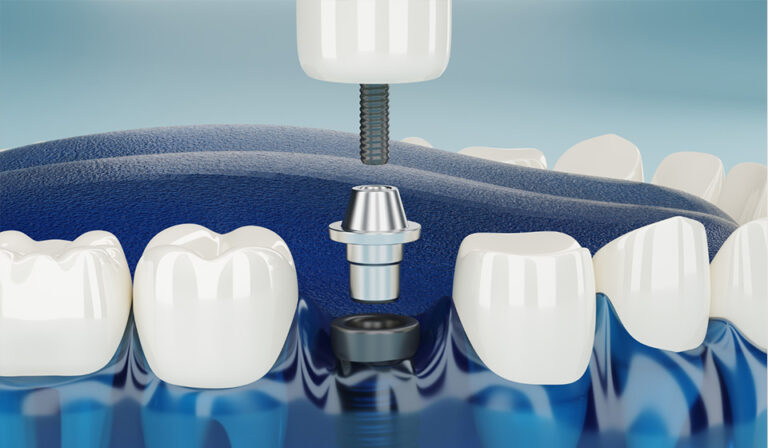 How Dental Implants Mimic Natural Teeth - Dentist Coral Gables ...
