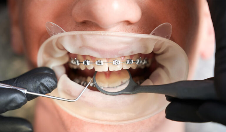 7 Common Dental issues That Orthodontics Treatment Can Fix